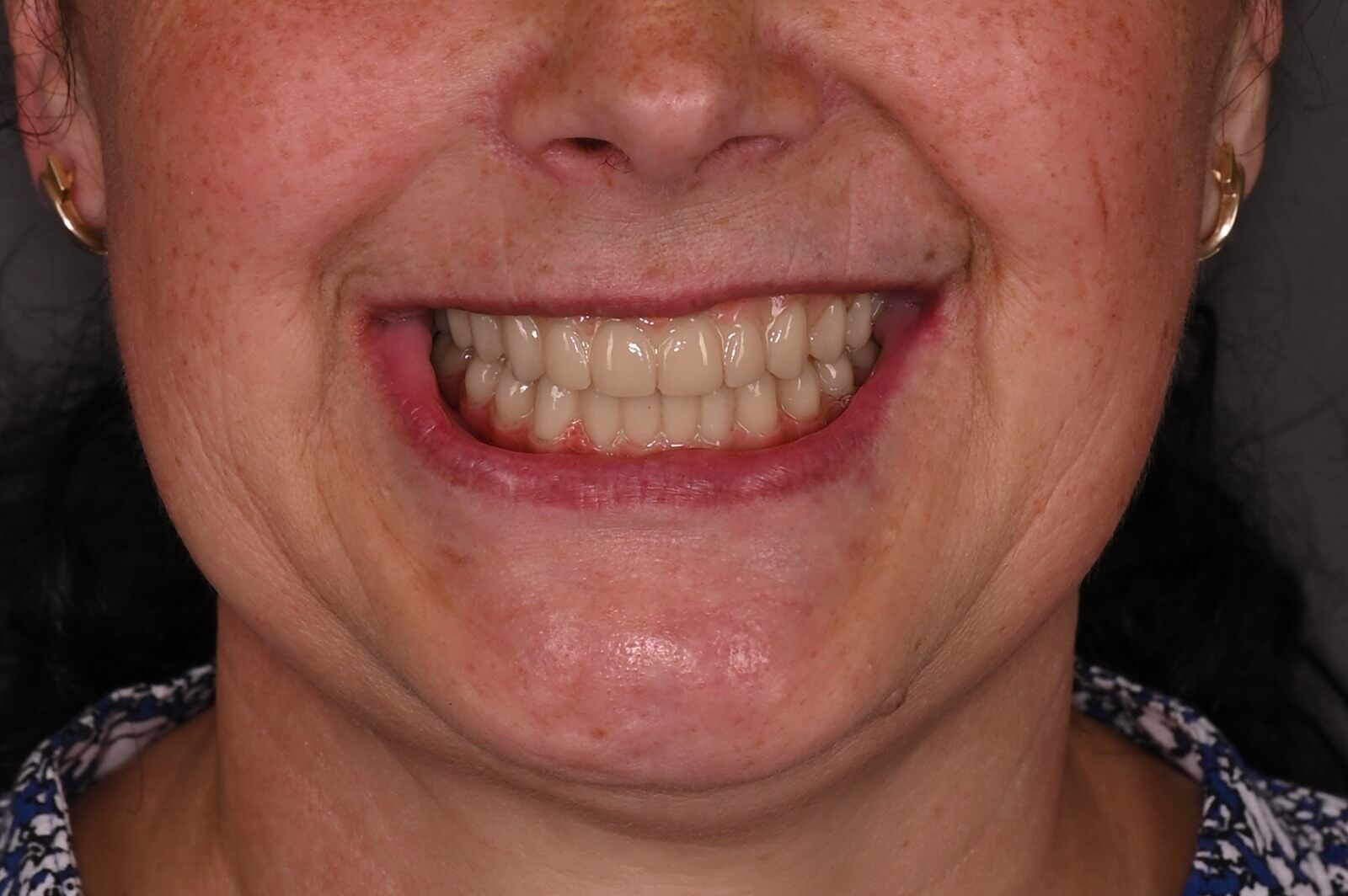 Dinți ficși într-o zi la Clinica Dr. Alin Odor